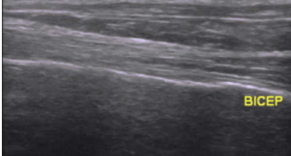 ORTHO - Shoulder joint effusion consistent with polyarthritis in a 6 ...