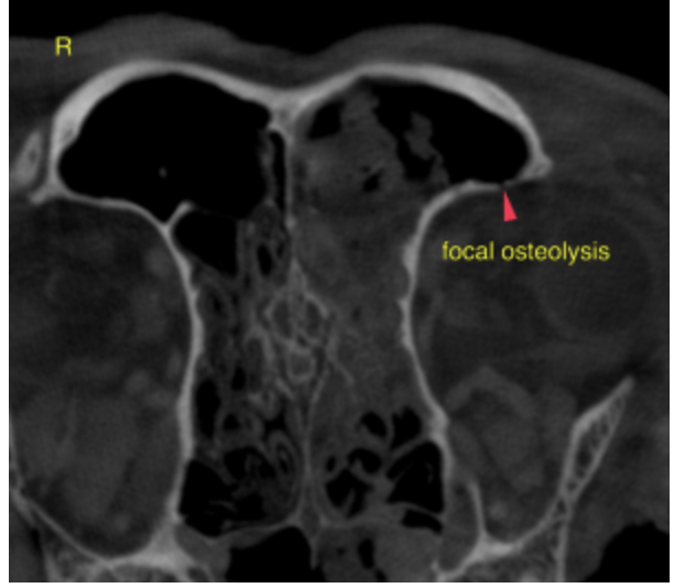 CT - Mycotic rhinitis with conchal and turbinate destruction in a 12 ...