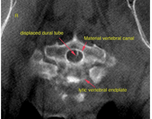 CT - Discospondylitis with vertebral canal stenosis and possible ...