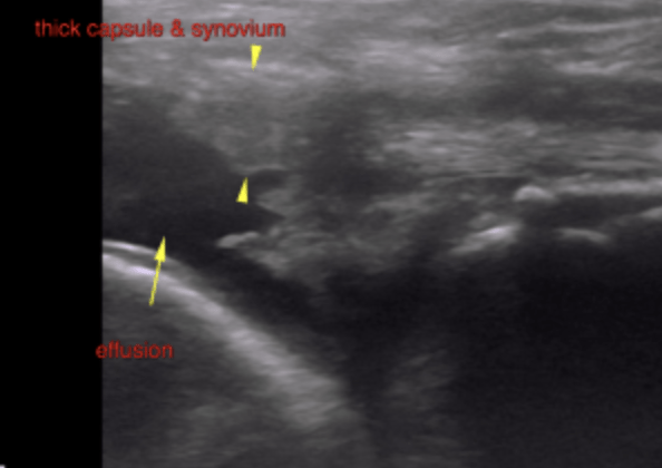 ORTHO - Cranial cruciate ligament (CCL) rupture with meniscal damage in ...
