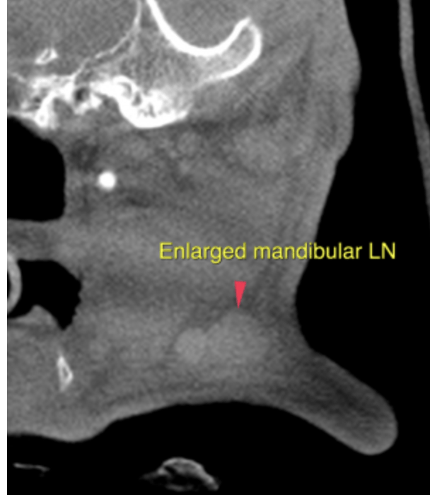 CT - Retrobulbar mass with compression of left ocular bulb in a 9 year ...